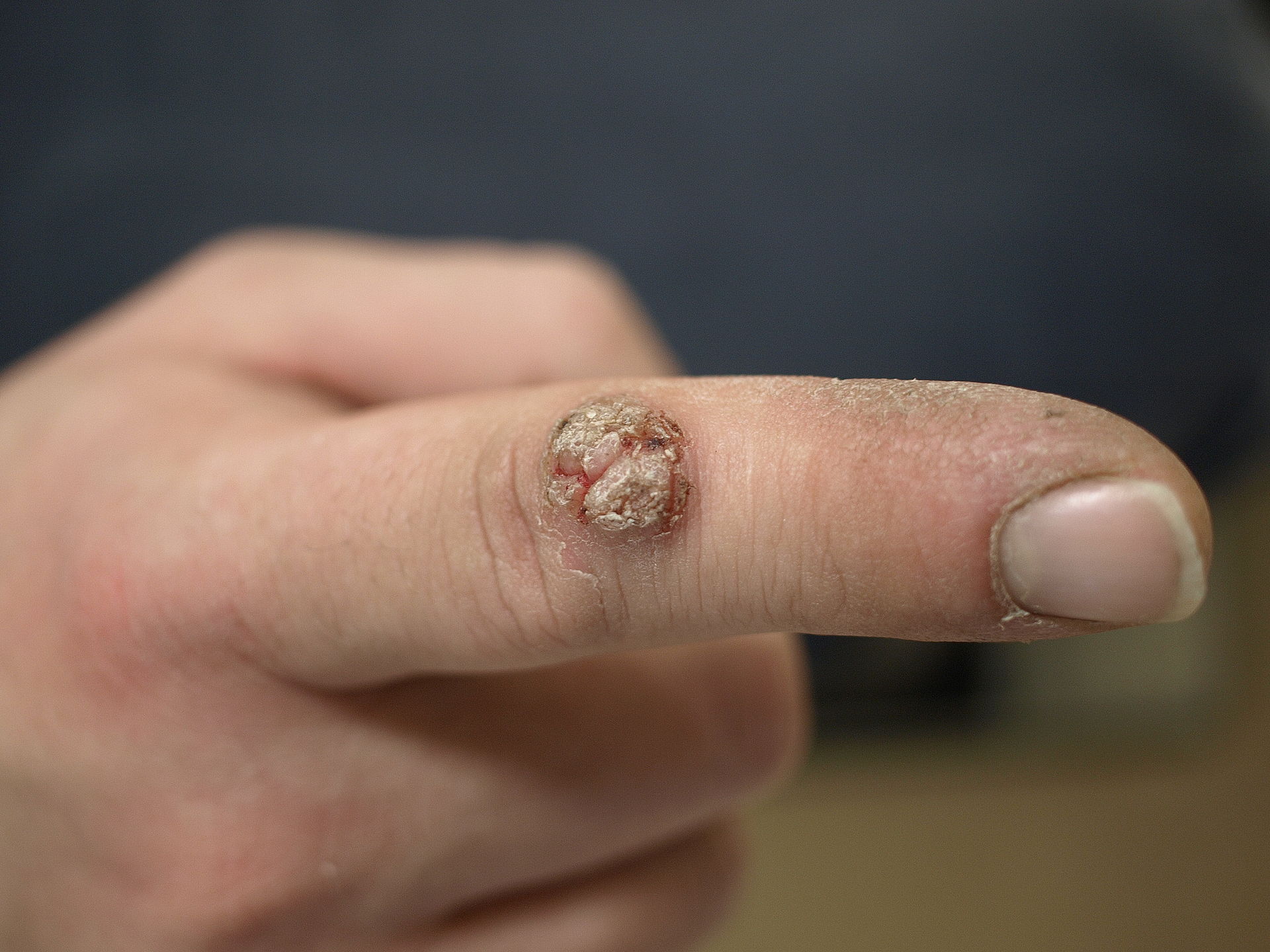 Warzen (HPV-Infektion): Symptome & Therapie - Online Hautarzt - AppDoc
