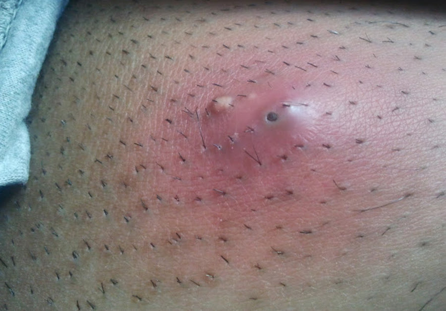 Abszess - Symptome und Behandlung - Online Hautarzt - AppDoc