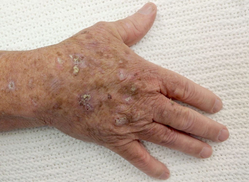 Aktinische Keratose - Aussehen, Online-Diagnose, Behandlung