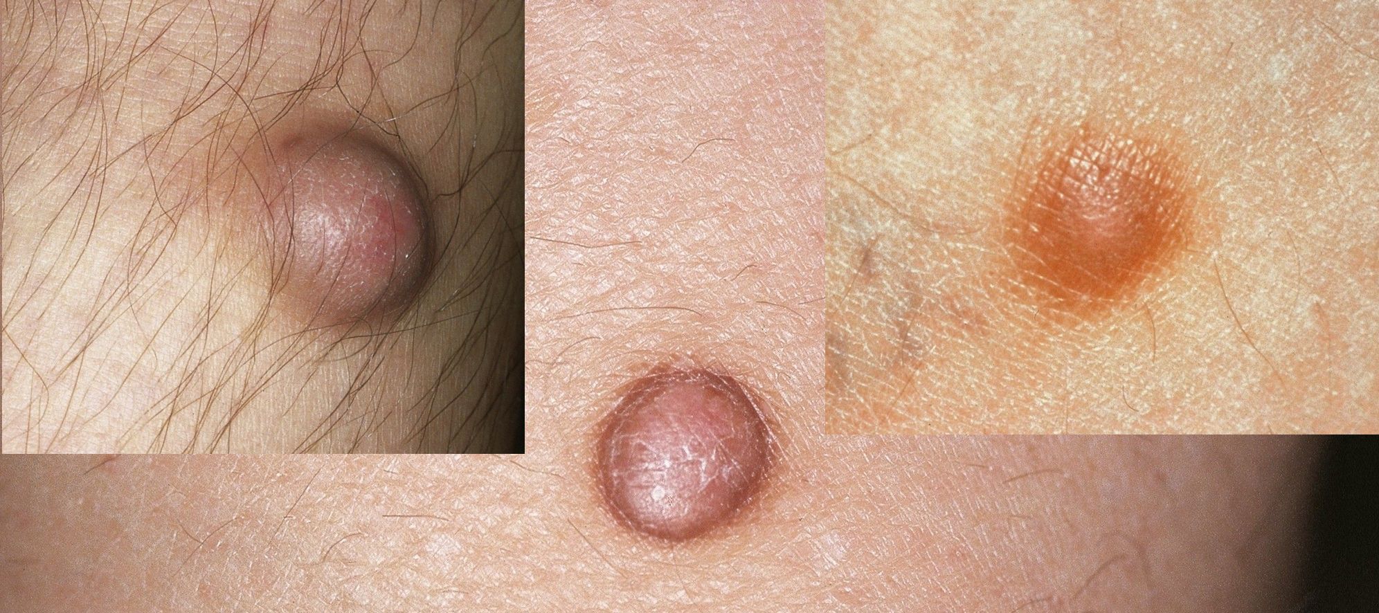 Dermatofibrom - was ist das? - Online Hautarzt - AppDoc