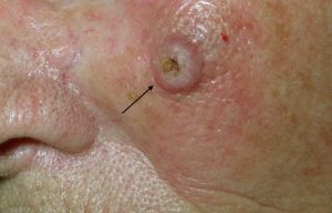Plattenepithelkarzinom (Spinaliom, weißer Hautkrebs): Online-Diagnose