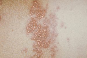 Blasen auf der Haut - Ursachen, Online-Diagnose & Therapie