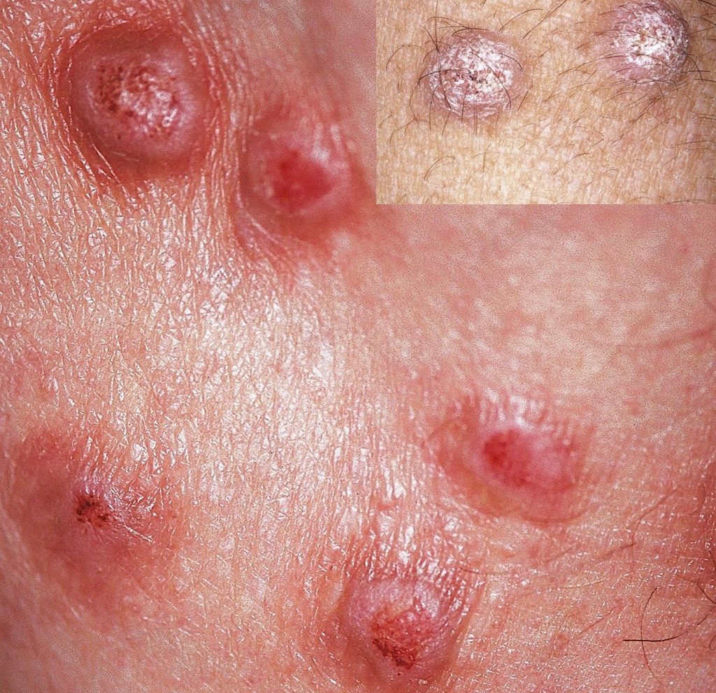 Prurigo nodularis: Ursachen, Aussehen, Online-Diagnose, Therapie
