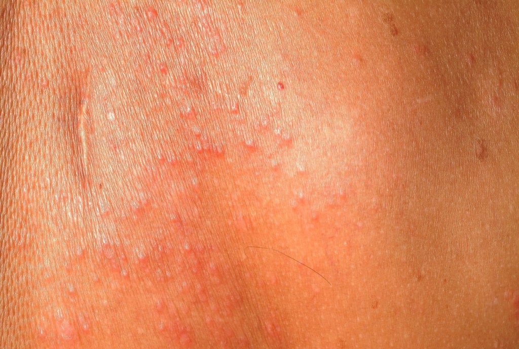 Whirlpool-Dermatitis - Ursachen & Online-Behandlung von Hautärzten