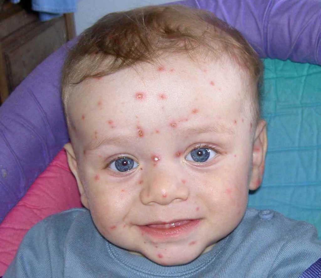 Windpocken - Ursachen, Symptome, Online-Diagnose & Therapie